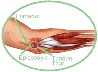 Lateral Epicondyle Injection
