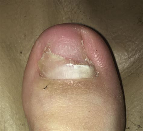 White Stuff Under Toenails