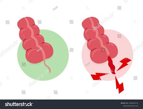 Comparison Between Inflamed Appendix Normal Appendix Stock Illustration 2196245711 Shutterstock