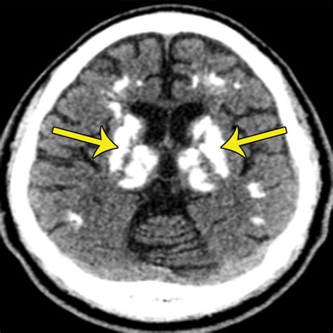 Advanced Early Onset Fahrs Disease A Case Report Pmc