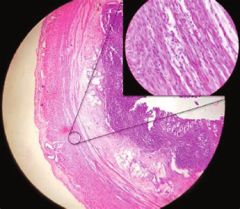 Histopathology Showing The Muscle Layer Of The Appendix Infiltrated Download Scientific Diagram