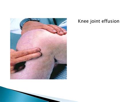 Unilateral Knee Replacement Vs High Tibial Osteotomy Pptx
