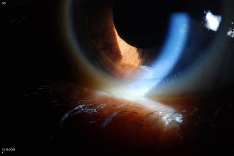 Retained Lens Fragments Retina Image Bank