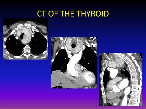 Ppt Imaging Of The Thyroid Powerpoint Presentation Free Download