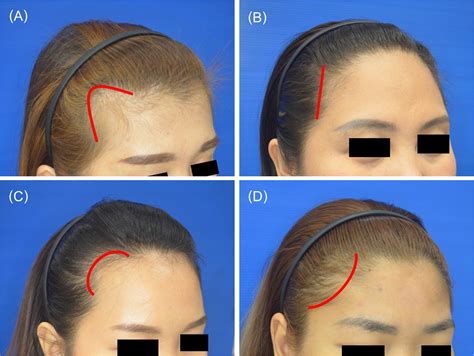 Straight Hairline Or Widows Peak