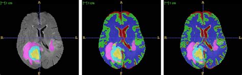 I Manual Segmentation Using SVM Ii Hierarchical SVM With Download Scientific Diagram