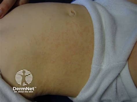 Unilateral Laterothoracic Exanthem