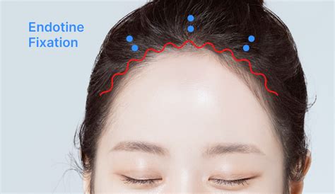 Forehead Reduction Ab Plastic Surgery