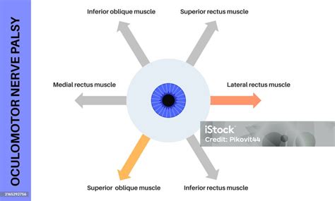 Oculomotor Nerve Palsy Stock Illustration Download Image Now Aging