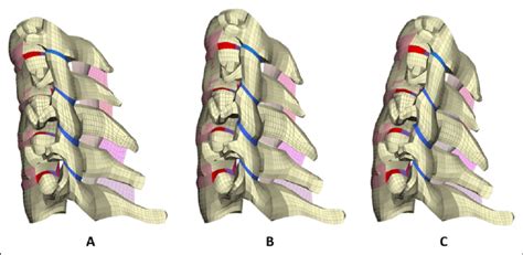 Finite Element Models Of Subaxial Cervical Spine With Varying Download Scientific Diagram