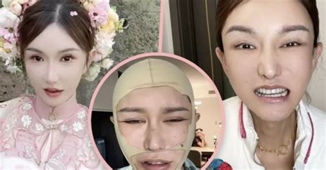 입·눈 다 삐뚤어졌다…구독 220만 中인플루언서 충격 성형