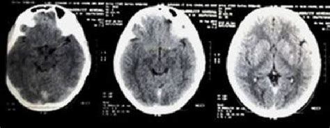 ct scan of brain showing hypodense shadow bilaterally not conforming to