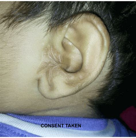 Epidermoid Cyst Of External Auditory Canal Presenting As Canal Atresia A Rare Case Report
