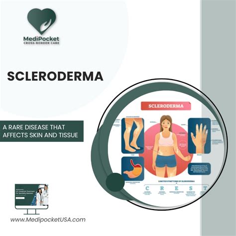 Scleroderma Affecting Skin And Tissue Learn More Scleroderma Affecting Skin And Tissue Learn More