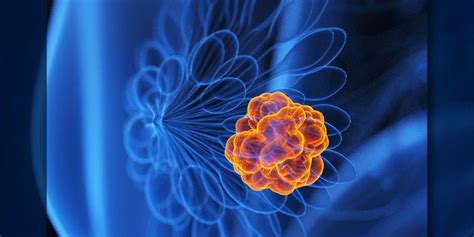 临床研究揭示：ctdna是早期乳腺癌远处复发风险的关键预测指标 Medfind