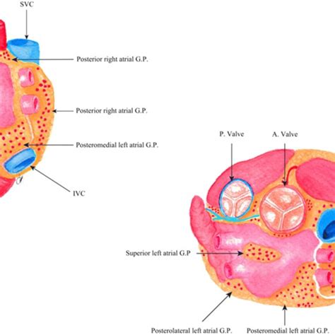 Division Of The Cardiac Ganglionic Plexus By Electrophysiologist