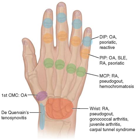 Sites Of Hand Or Wrist Involvement And Their Potential Disease Associations DIP Distal