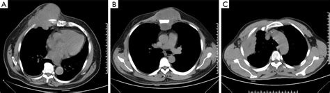 Cpt Code Soft Tissue Mass Chest Wall Acetojapanese