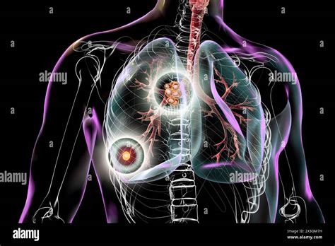 Illustration Of Primary Lung Tuberculosis With The Ranke Complex