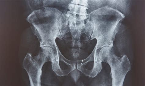 Flexible X Ray Detectors Could Revolutionise” Cancer Care Health