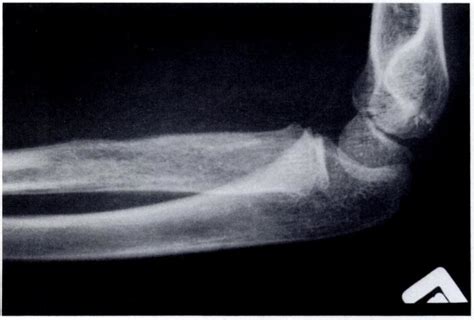Ewings Sarcoma Increased Uptake In The Scintignam A Of The Left Download Scientific Diagram