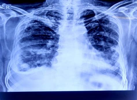 Pulmonary Aspergillosis With Pyopneumothorax A Case Report Himalayan Journal Of Community