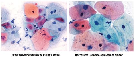 Papanicolaou Pap Staining Introduction Principle Procedure And Interpretation