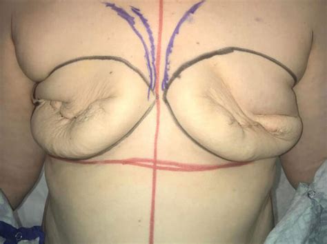 Breast Reconstruction Before And After 13 Park And Rebowe