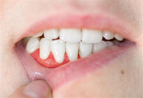 What To Do When You Have Inflamed Gums Sunset Dental Care