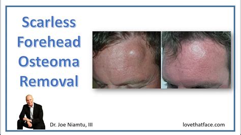 Osteoma Forehead Multiple Peripheral Osteomas Of Forehead Report Of A