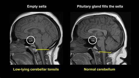 Intracranial Brain Hemorrhage Detection Project Using Cnn