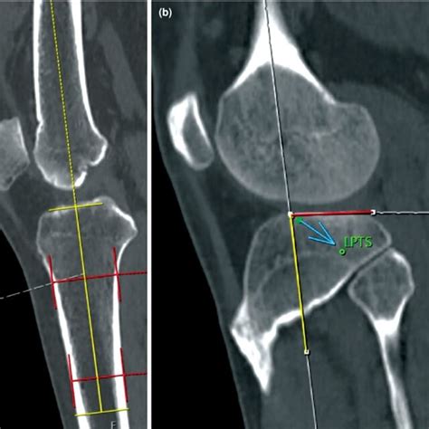 A Proximal Tibial Longitudinal Axis In True Sagittal Plane Yellow Download Scientific