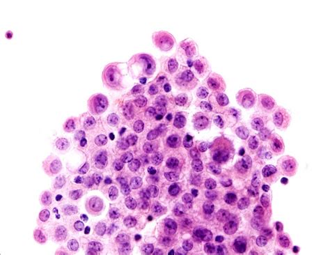 Malignant Effusions Eurocytology