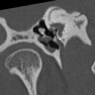 Sagittal CT Scan Of Right Temporal Bone Showing An Enlarged Canal Of Download Scientific