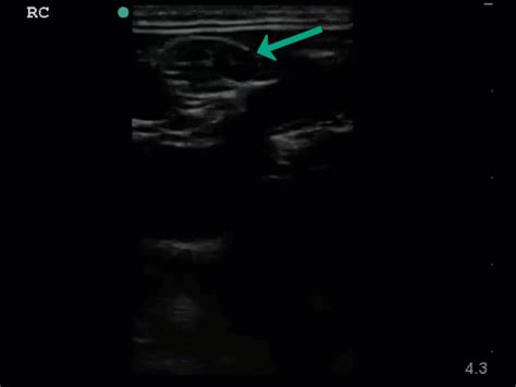 Lower Extremity Dvt Toronto Internal Medicine Pocus
