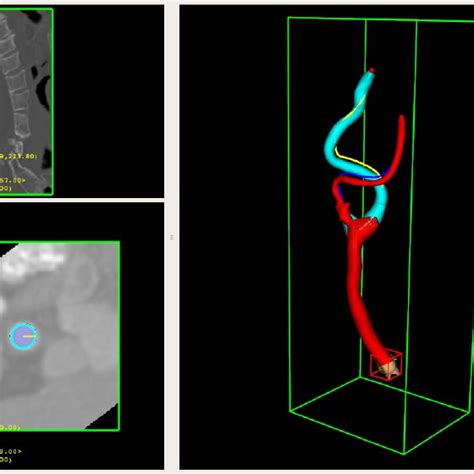 Example Of The Segmentation Of A Cta Image Of A Carotid Using Our Download Scientific Diagram