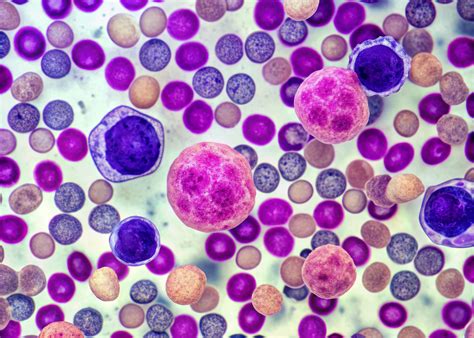Deep Responses In Smoldering Multiple Myeloma Linked To Improved Outcomes