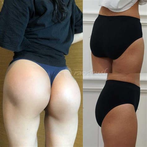 Buttock Augmentation Gallery Lelux Hospital