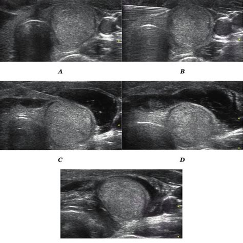 Conduction Of Liquid Isolation Method Under Ultrasound Guidance A