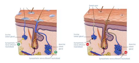 Hyperhidrosis Treatment Thomas D Esthetique