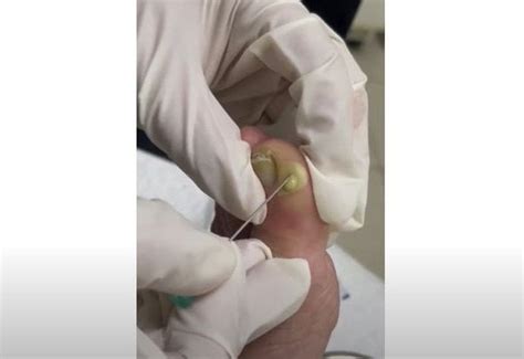 Toe Abscess Pus Draining Rpimplepopperdelight