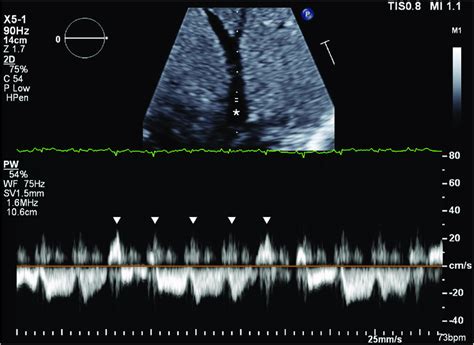 Subcostal View On TTE Of The Hepatic Vein Insertion Into The IVC Download Scientific