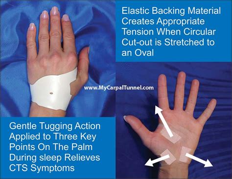 Median Nerve Injury Splint