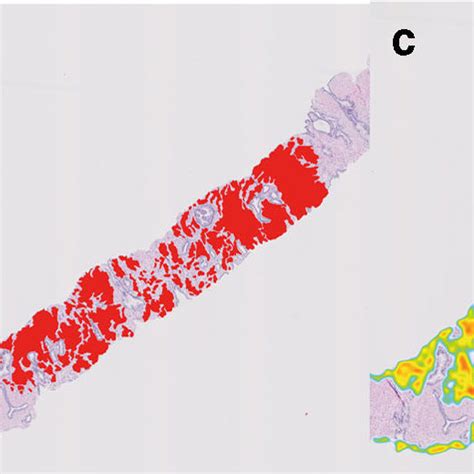 A Hande Biopsy Fragment B Ground Truth Manual Annotations Of Gp 4 C