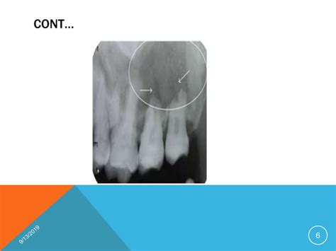 Differential Diagnoses And Management Of Mandibular Radiolucent Lesions Pptx Dental Health