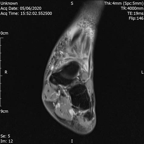 Undisplaced Fracture Distal Tibial Metaphysis Cases Home