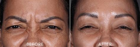 Daxxify Marketing Content