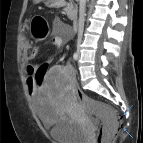 Rectal Pneumatosis Air Is Present In The Wall Of The Rectum As