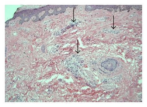 50 Year Old Male Presenting With Diffuse Confluent Leukoencephalopathy