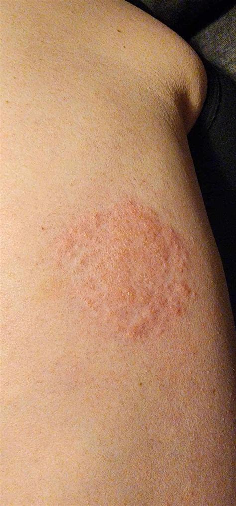 Allergic Reaction R Dexcom